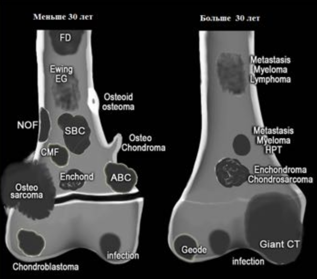 Неоссифицирующая фиброма (метафизарный фиброзный дефект) - Microsievert.ru